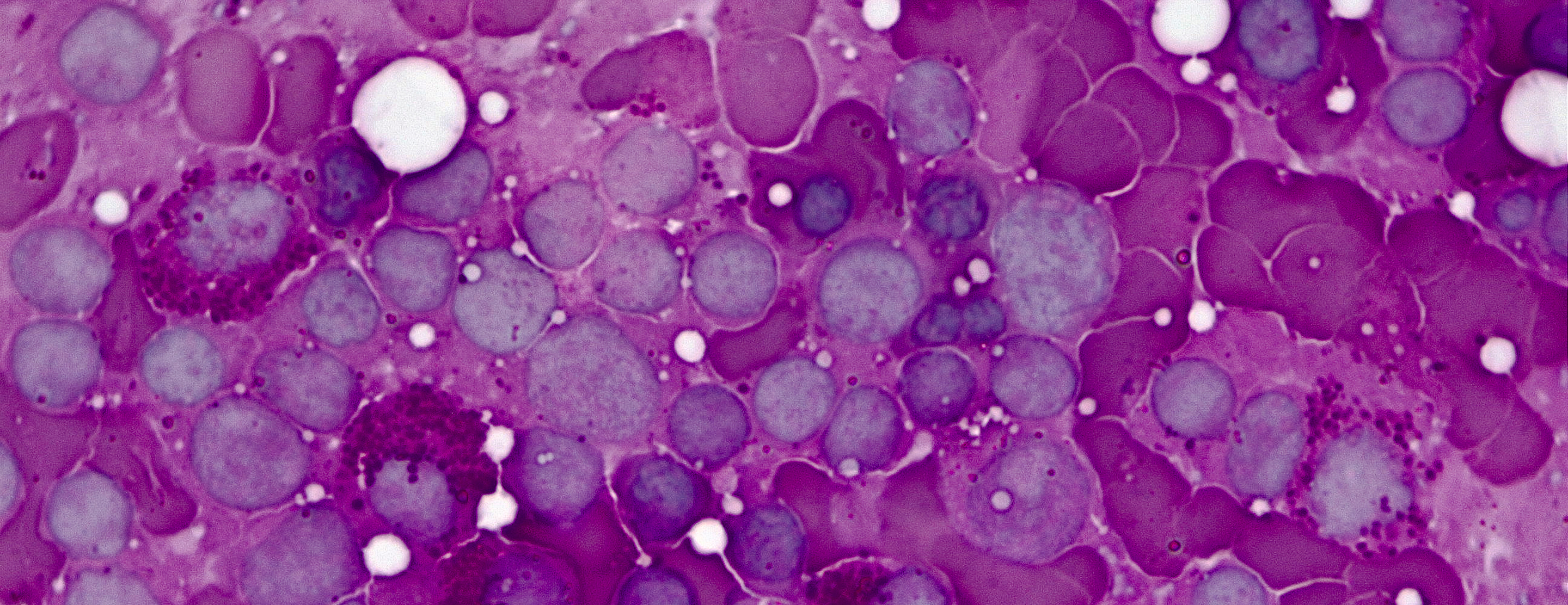 What Is Bone Marrow Patient Education UCSF Benioff Children s What Is Bone Marrow Patient Education UCSF Benioff Children s
