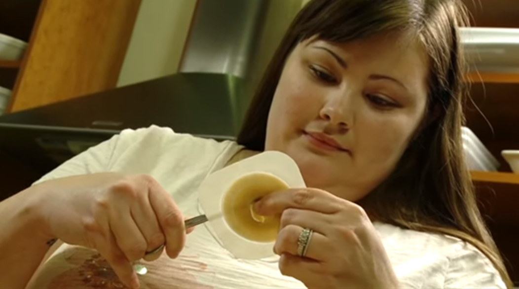 Stoma Care for Children and Their Families | Patient Education | UCSF ...