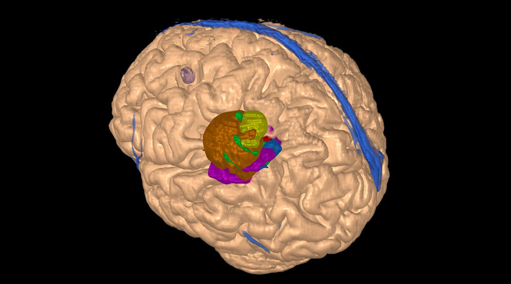 Virtual Reality Transforming Brain Surgery for Patients and Providers ...