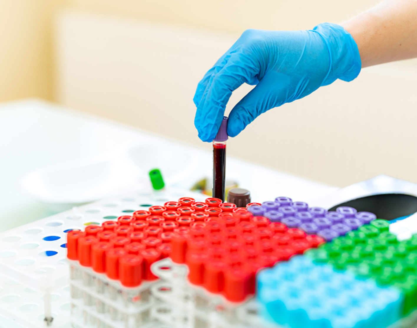 Anti DNase B Blood Test Anti DNase B Blood Test