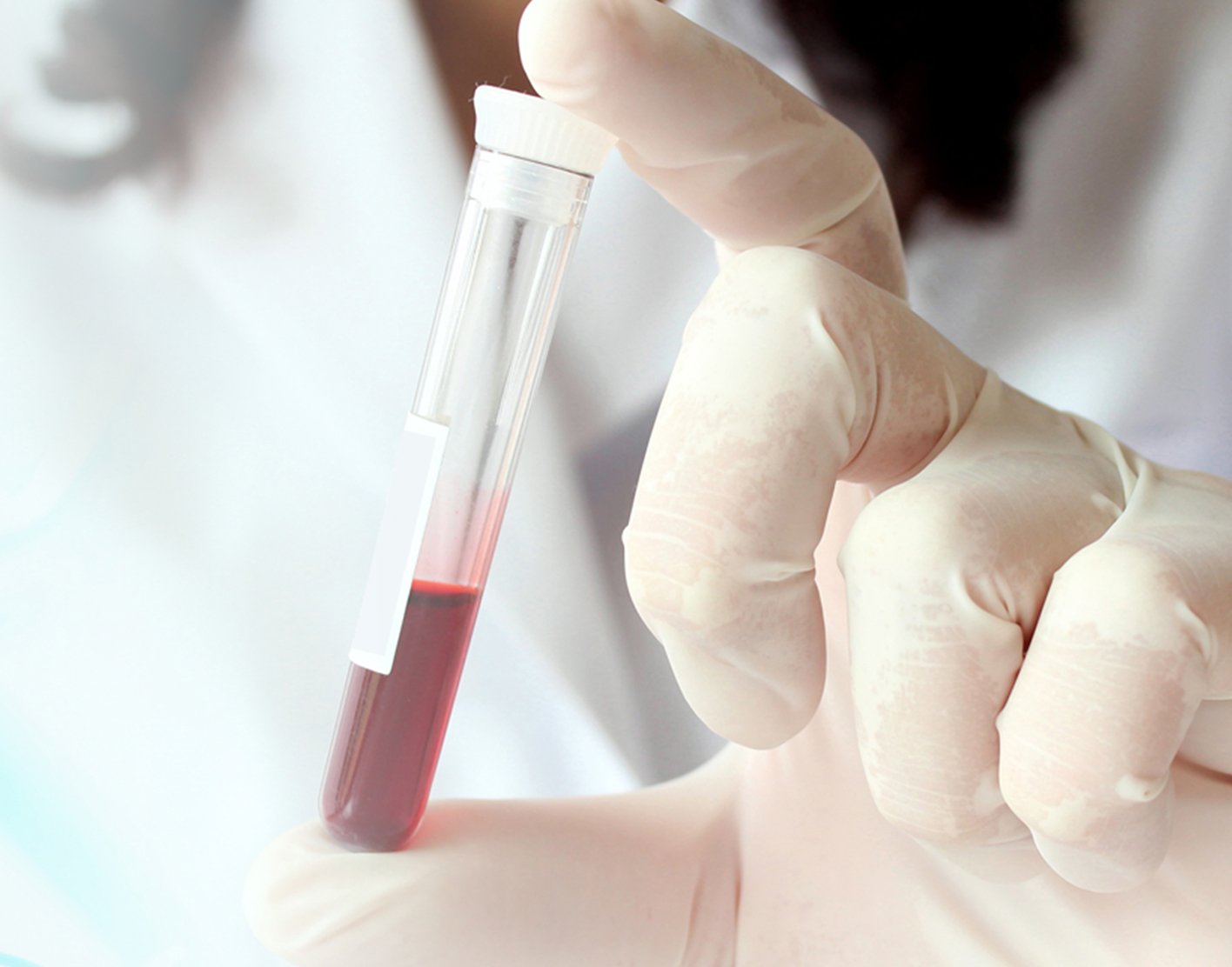 Catecholamine blood test