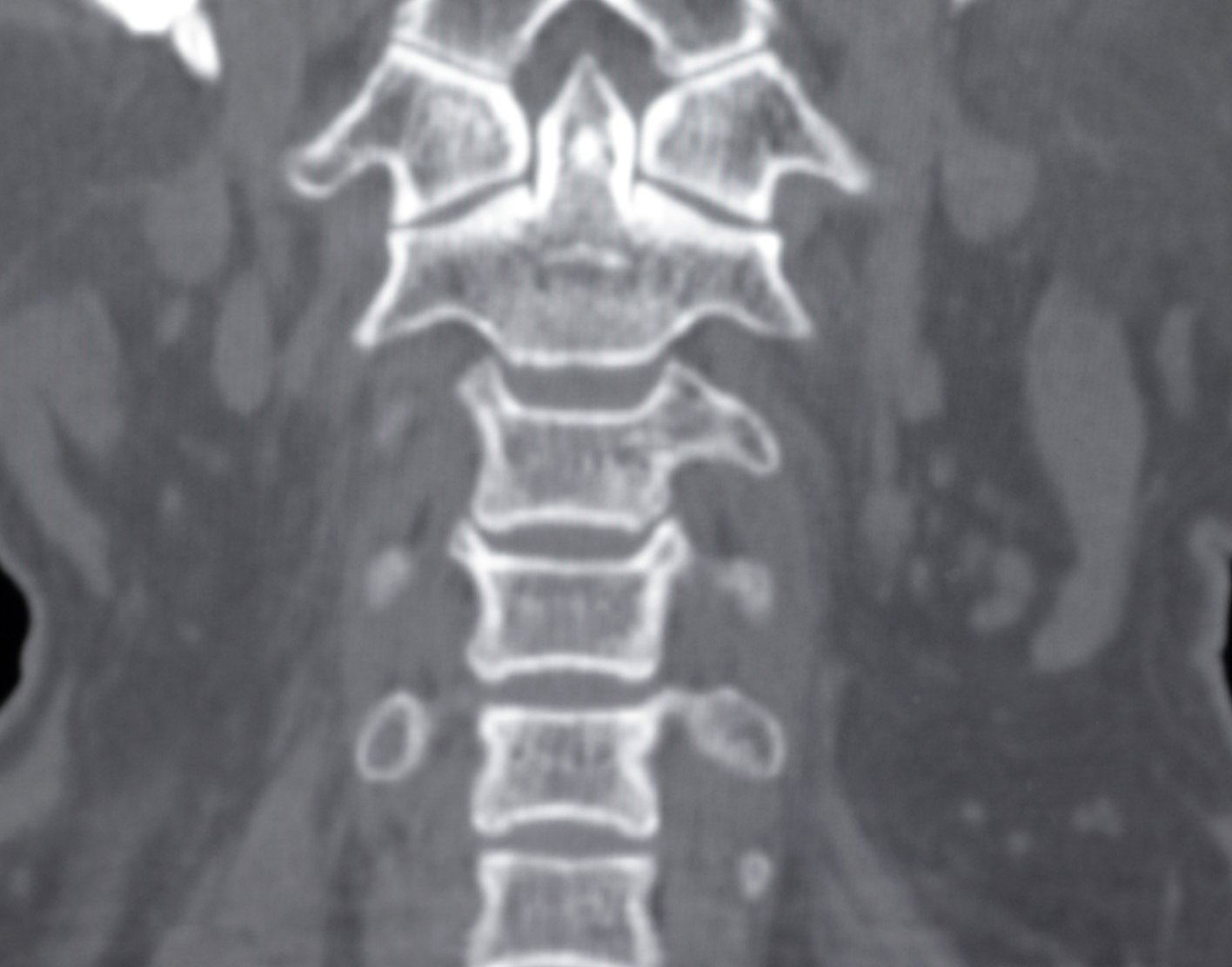 Cervical spine CT scan