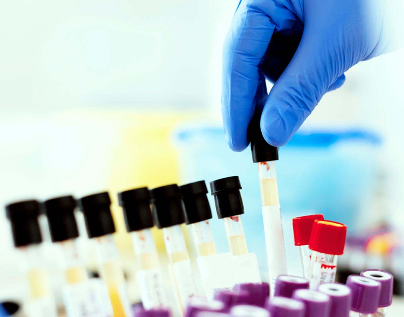 Creatinine urine test