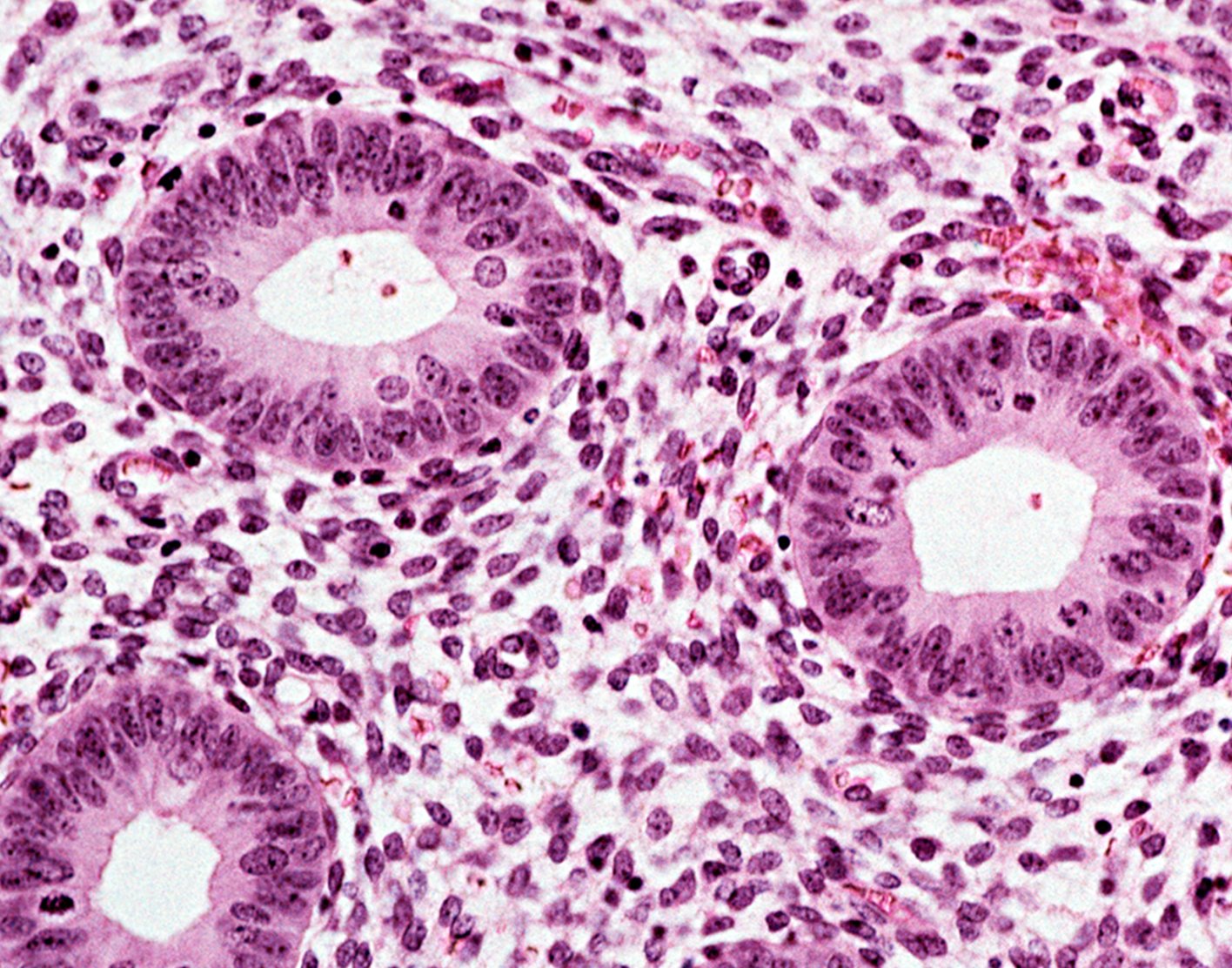 Abnormal Endometrial Biopsy Study Flowchart. AUB: Abnormal Uterine