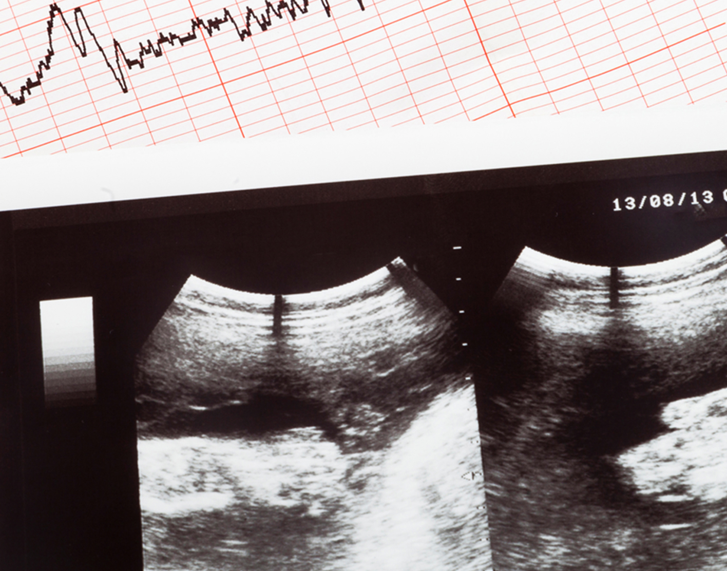Fetal echocardiography
