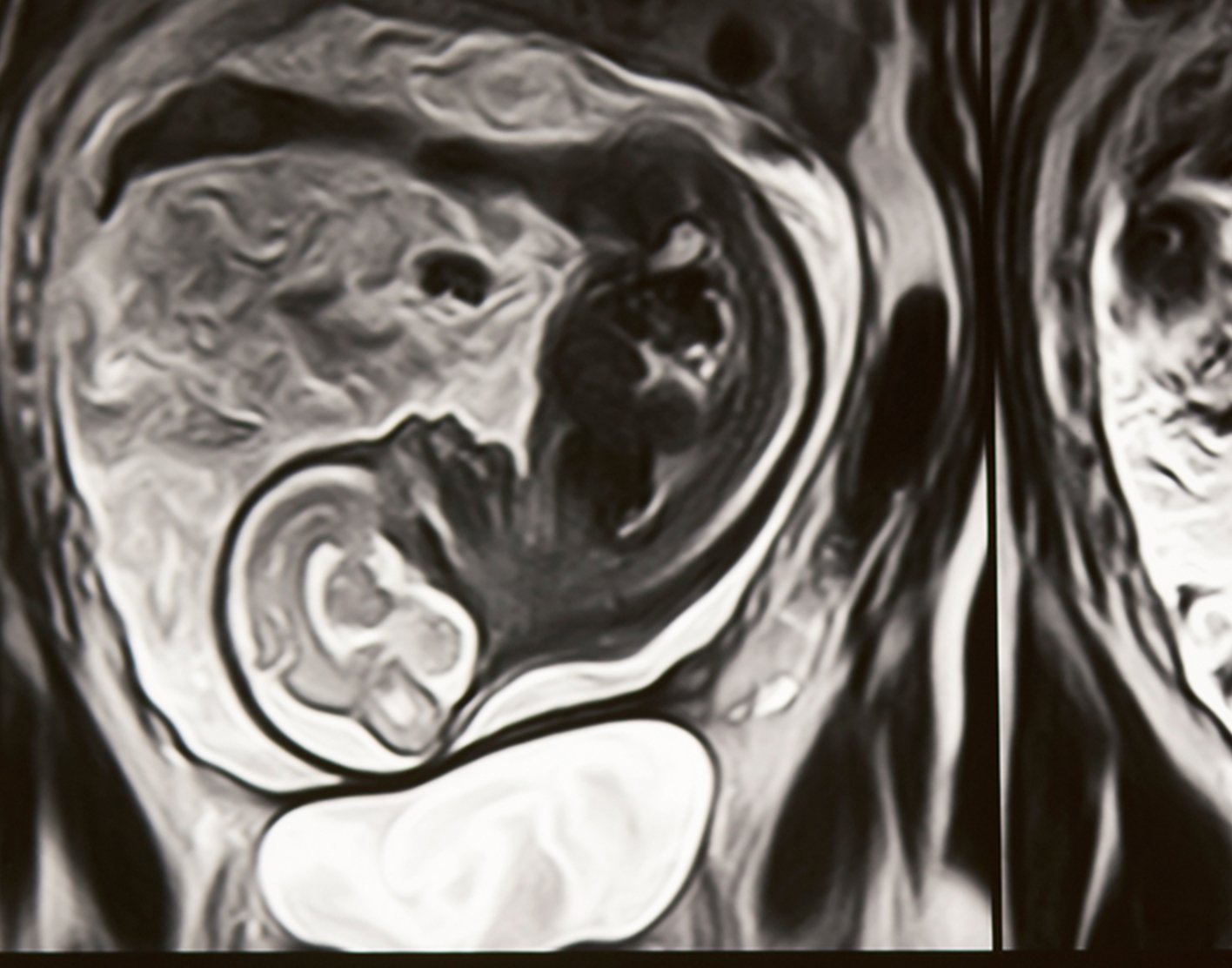 Fetal MRI | UCSF Benioff Children's Hospitals
