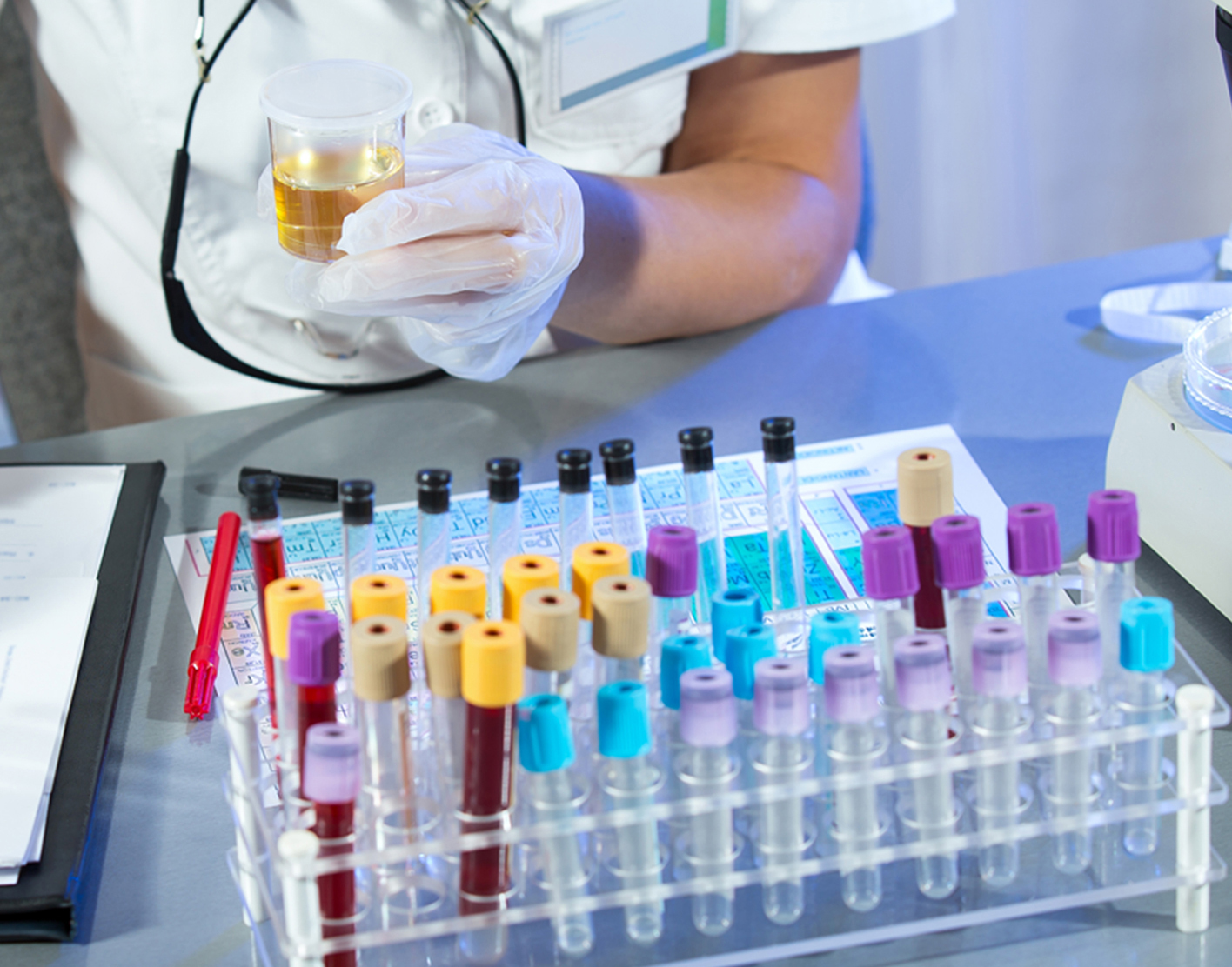 Glucose Urine Test Glucose Urine Test