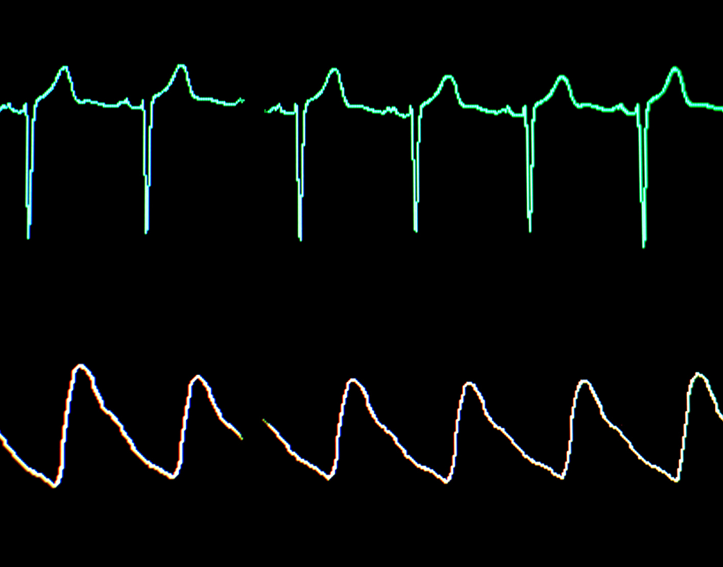 His Bundle Electrogram