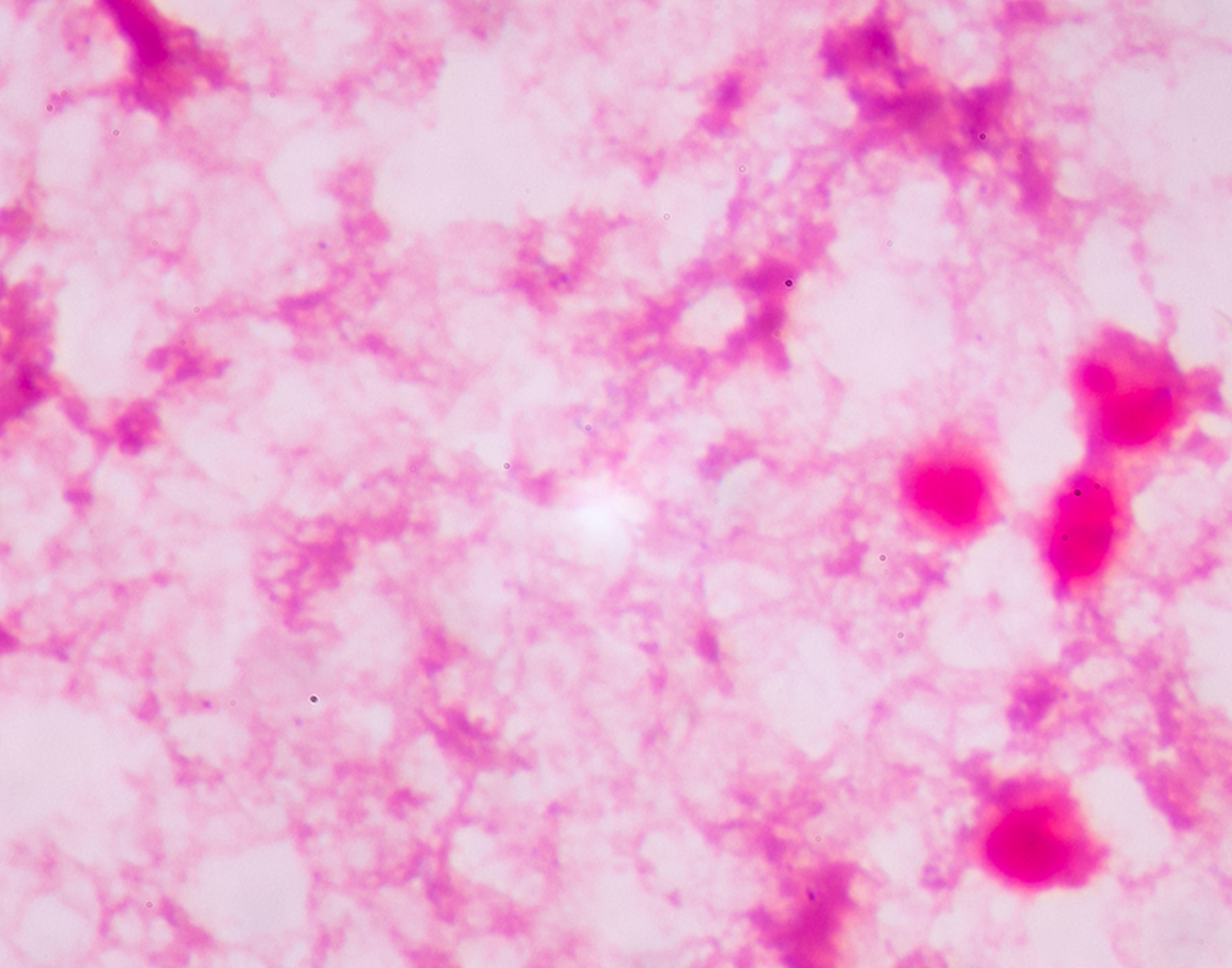 Pleural fluid analysis